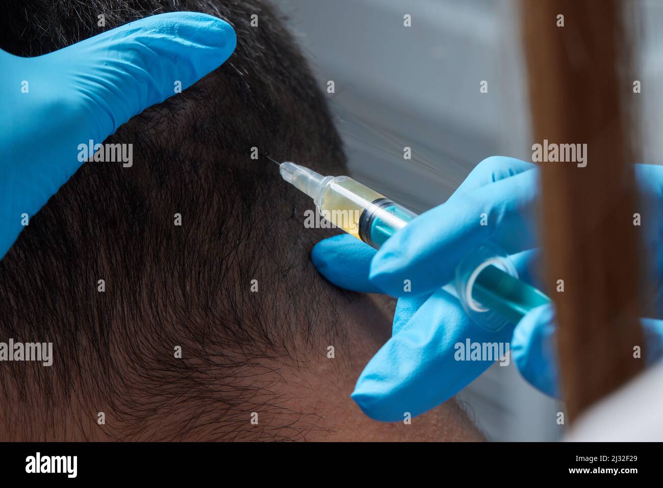 Injection plasma into head hair man cosmetologist doctor Stock Photo ...