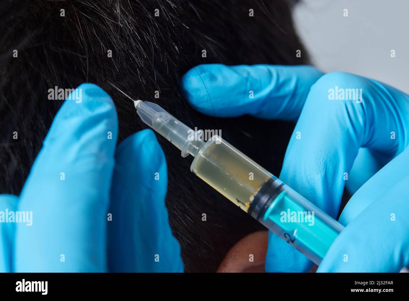 Injection plasma into head hair man cosmetologist doctor Stock Photo ...