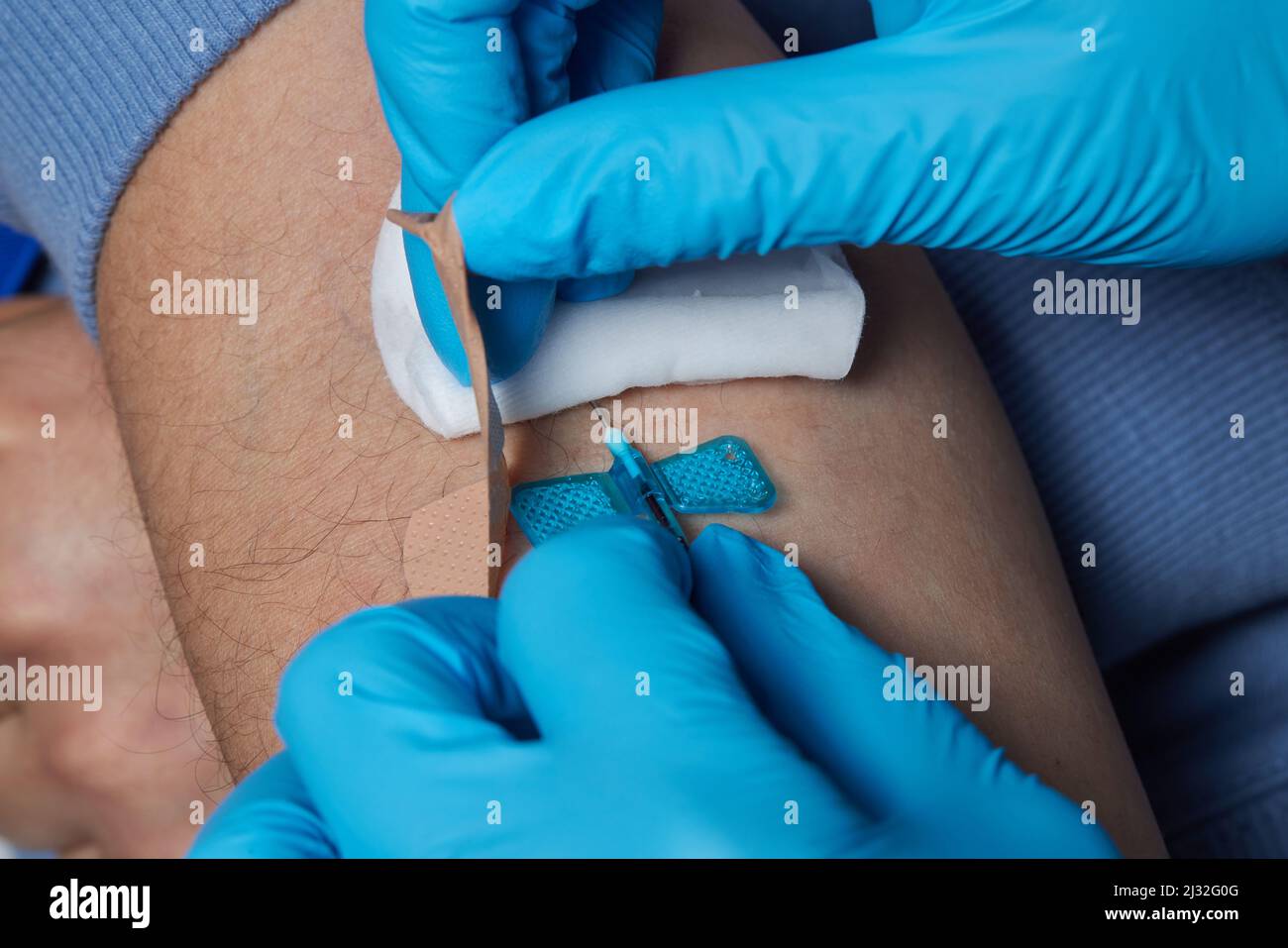 Tuberculosis test arm hi-res stock photography and images - Alamy