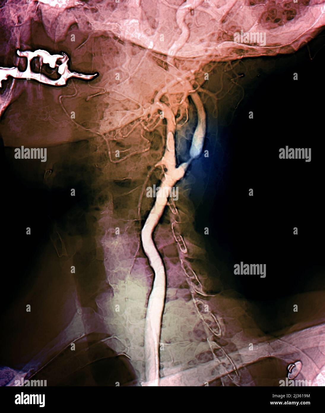 Narrowed carotid artery, digital angiogram Stock Photo - Alamy