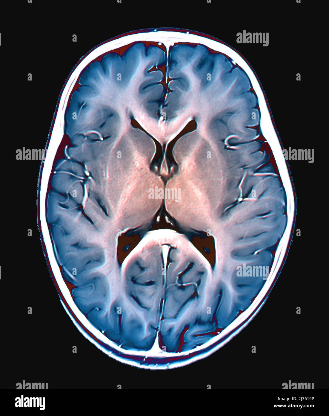 Healthy brain, MRI scan Stock Photo - Alamy