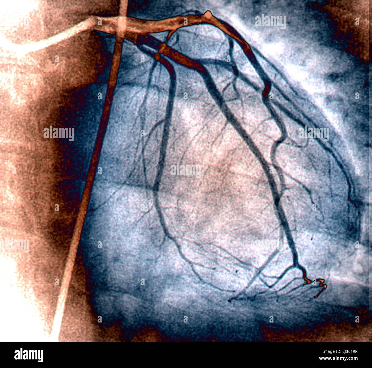 Normal left coronary network, angiogram Stock Photo - Alamy
