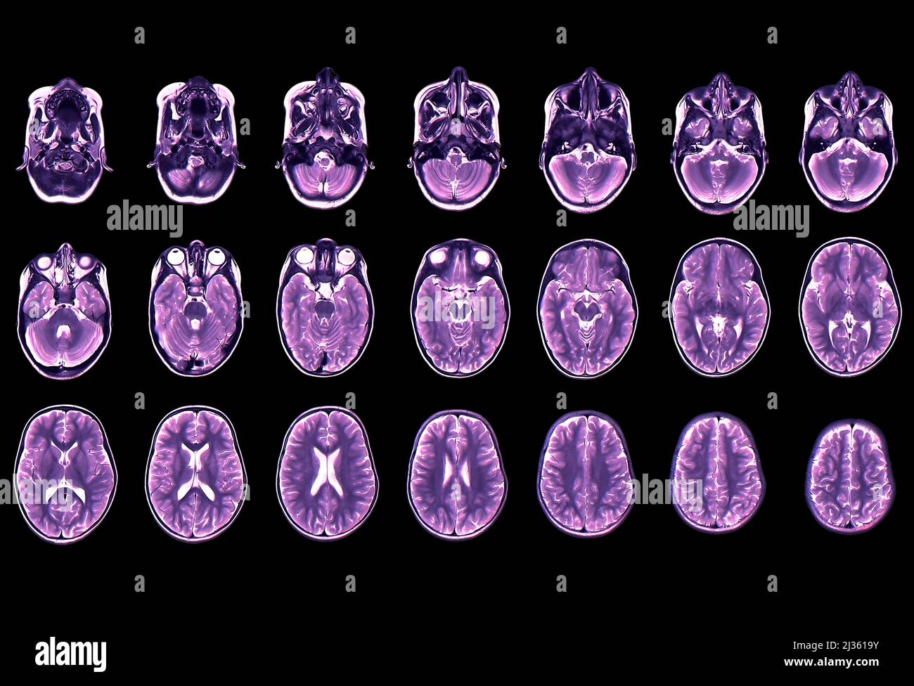 Normal brain of a child, MRI scans Stock Photo - Alamy