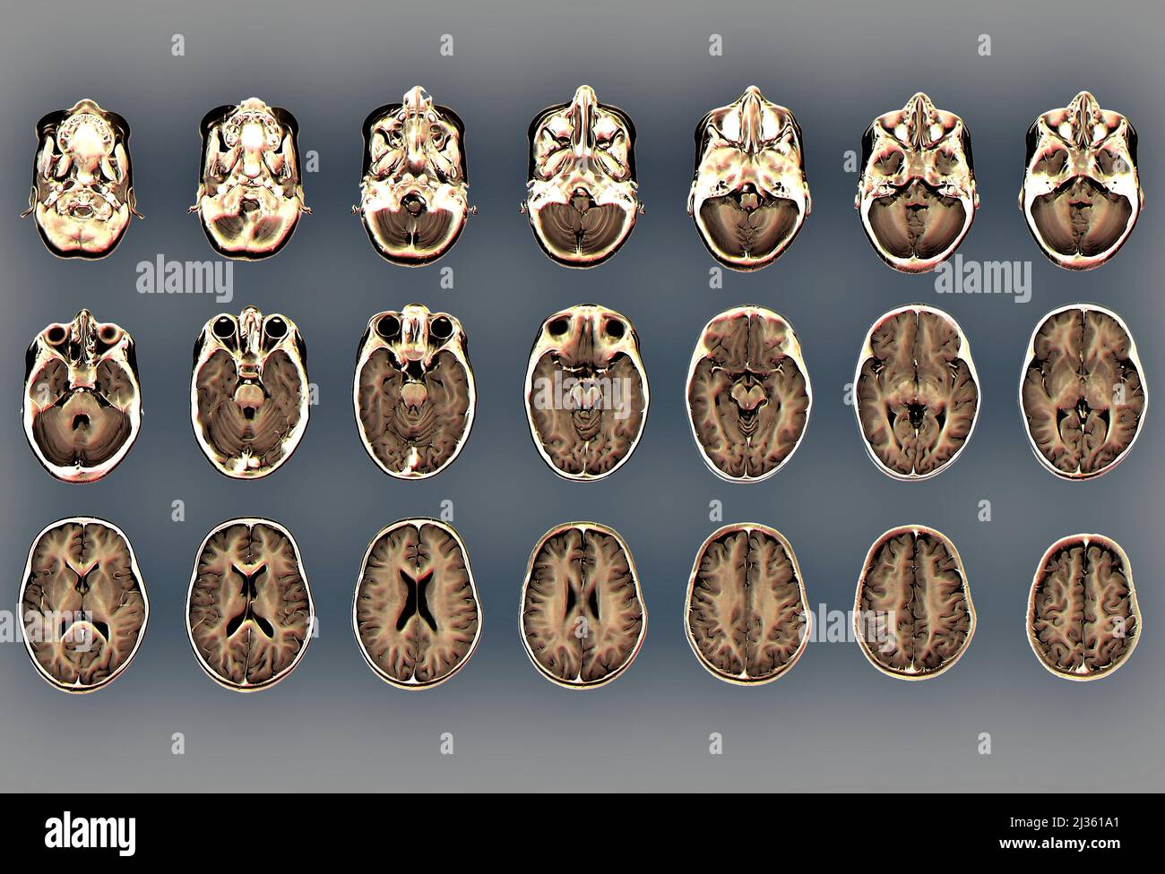 Normal brain of a child, MRI scans Stock Photo - Alamy