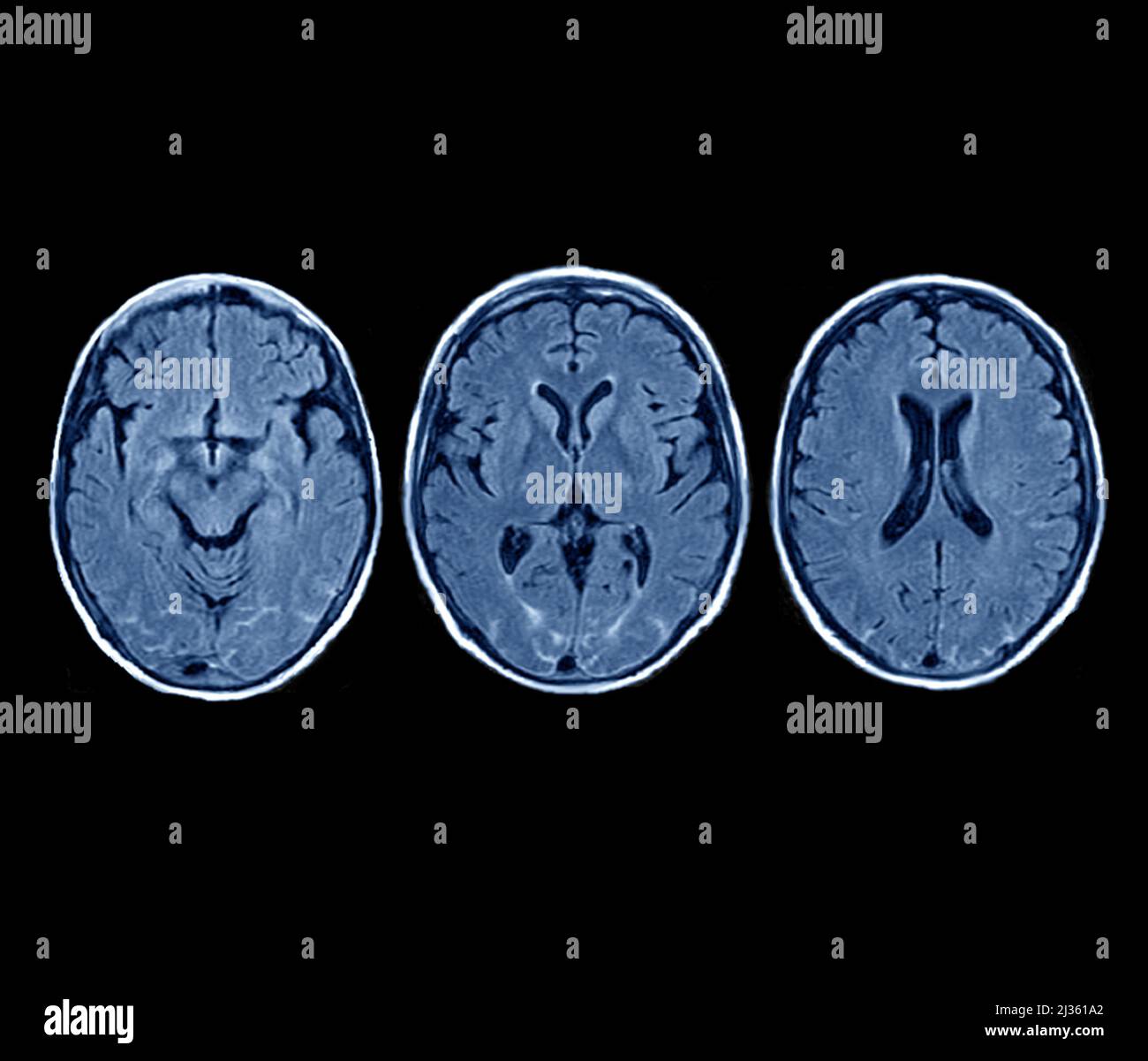 Subarachnoid haemorrhage, MRI scans Stock Photo - Alamy