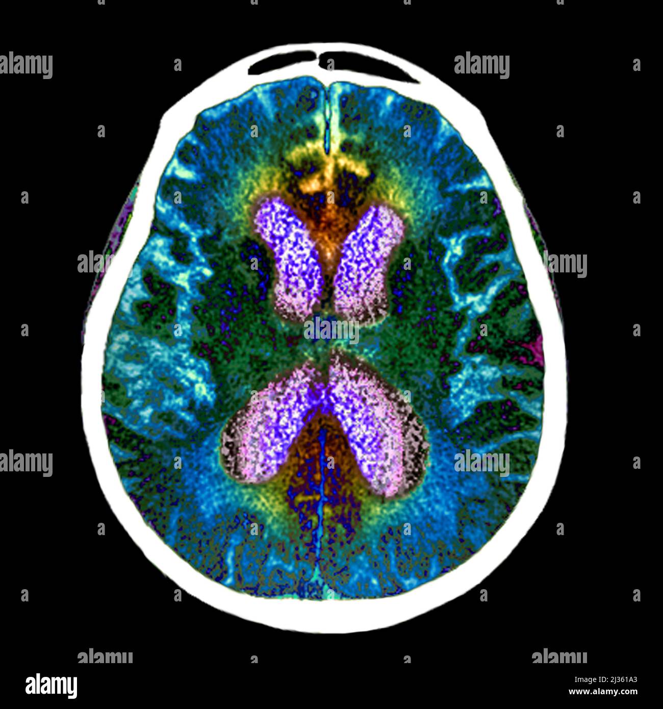 Alzheimer's disease, CT scan Stock Photo - Alamy