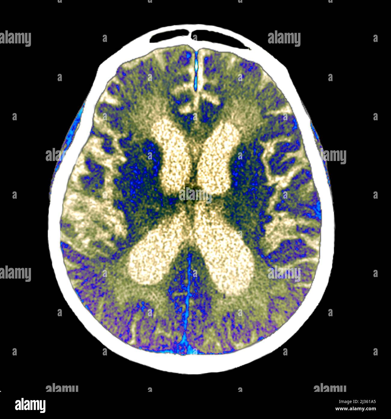 Alzheimer's disease, CT scan Stock Photo - Alamy