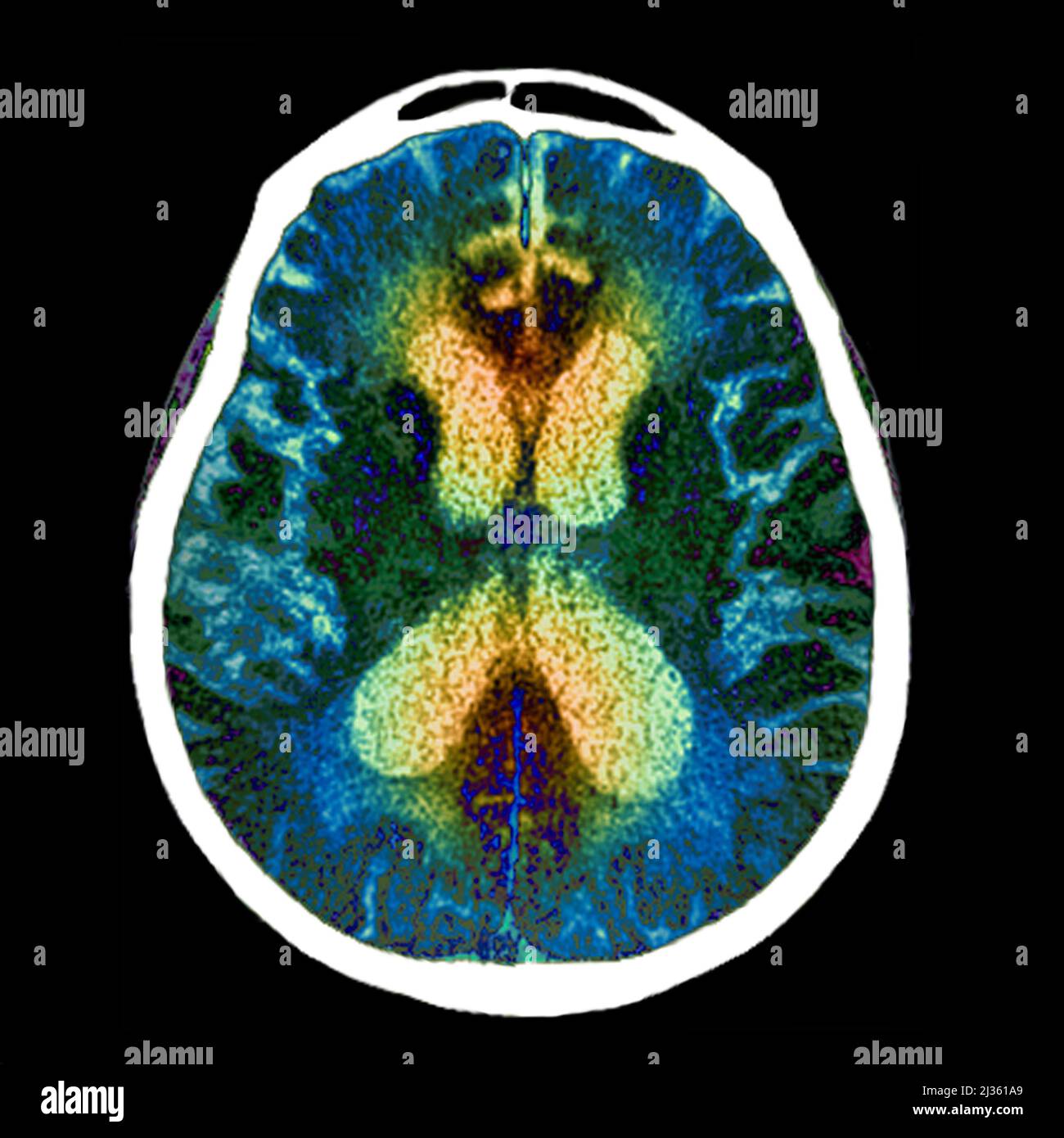 Alzheimer's disease, CT scan Stock Photo - Alamy