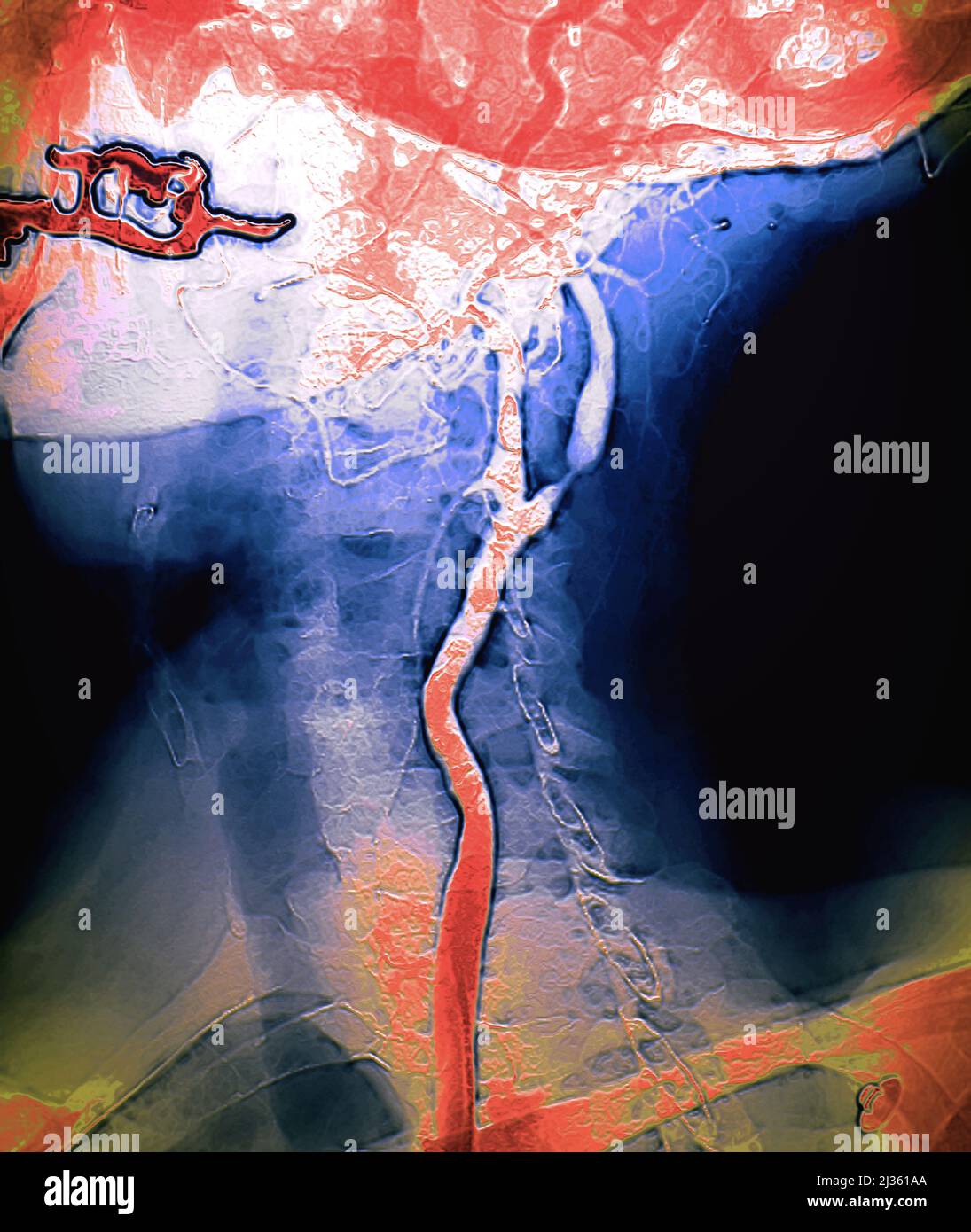 Narrowed carotid artery, digital angiogram Stock Photo - Alamy