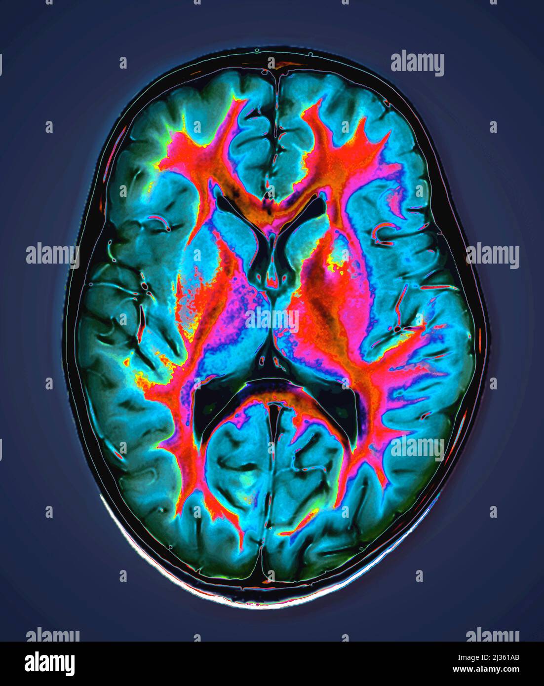 Healthy Brain Mri