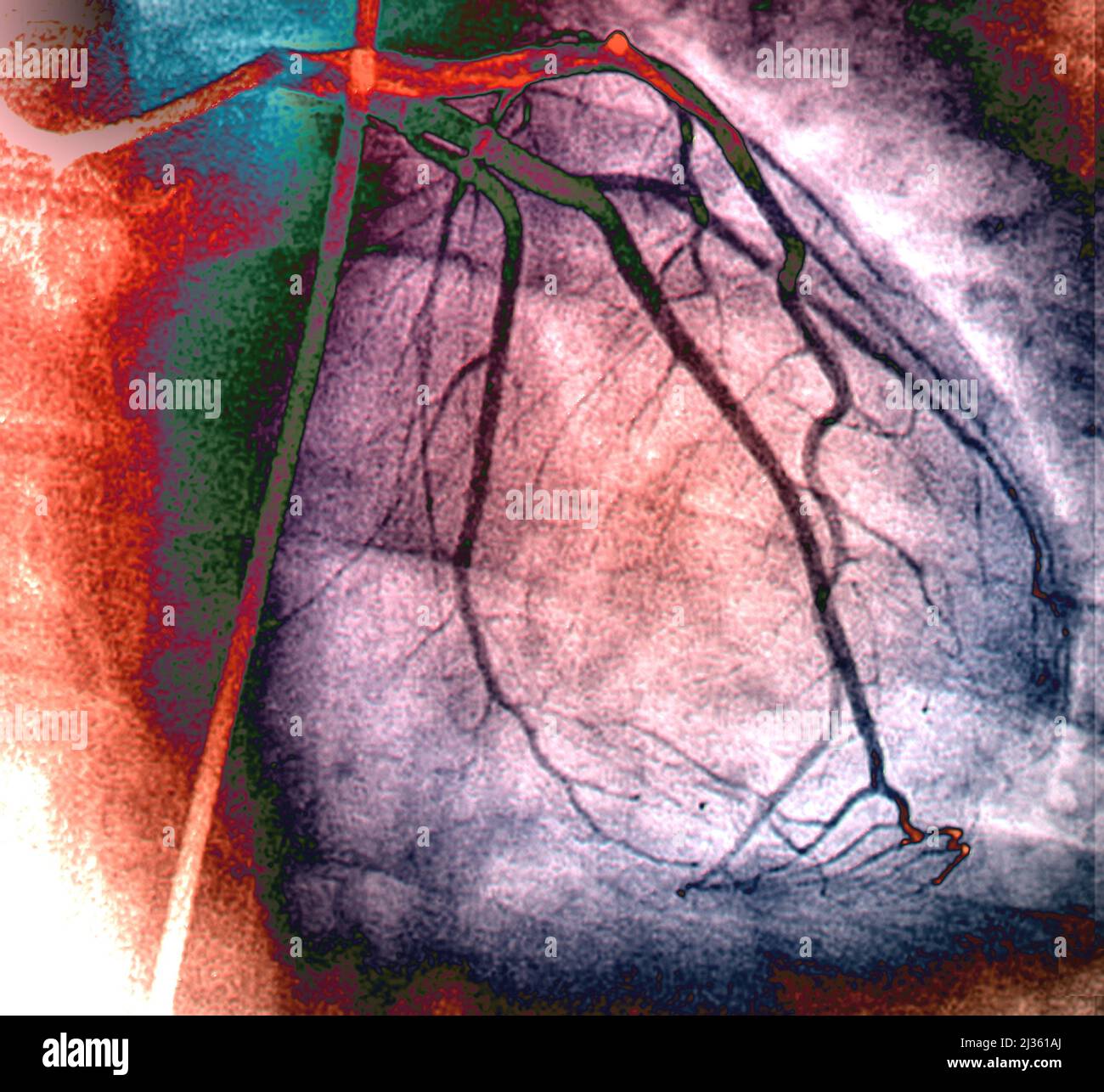 Normal left coronary network, angiogram Stock Photo - Alamy