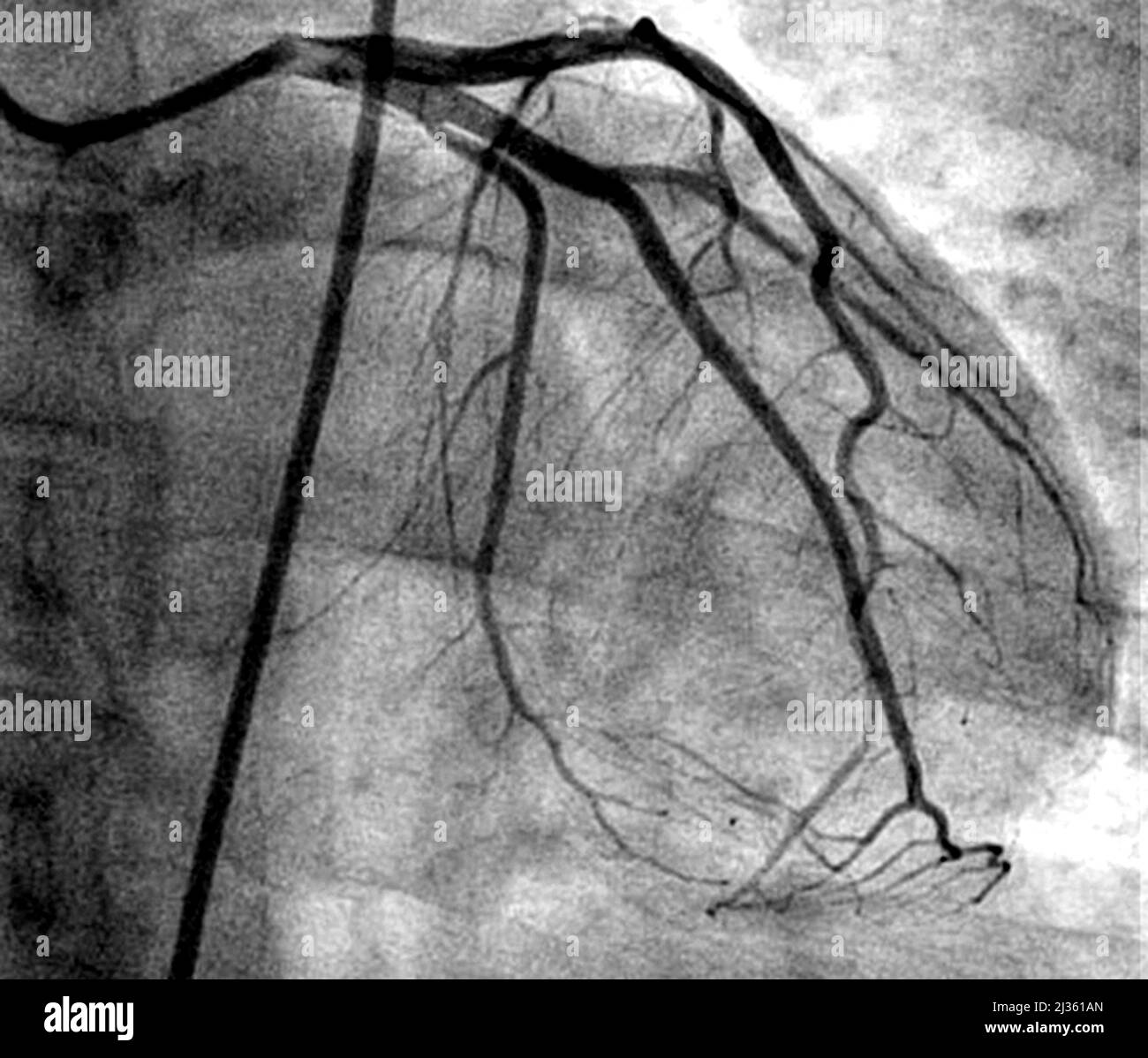 Normal left coronary network, angiogram Stock Photo - Alamy