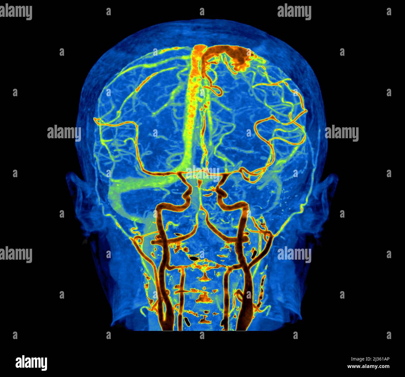 Arteriovenous malformation, CT angiogram Stock Photo - Alamy