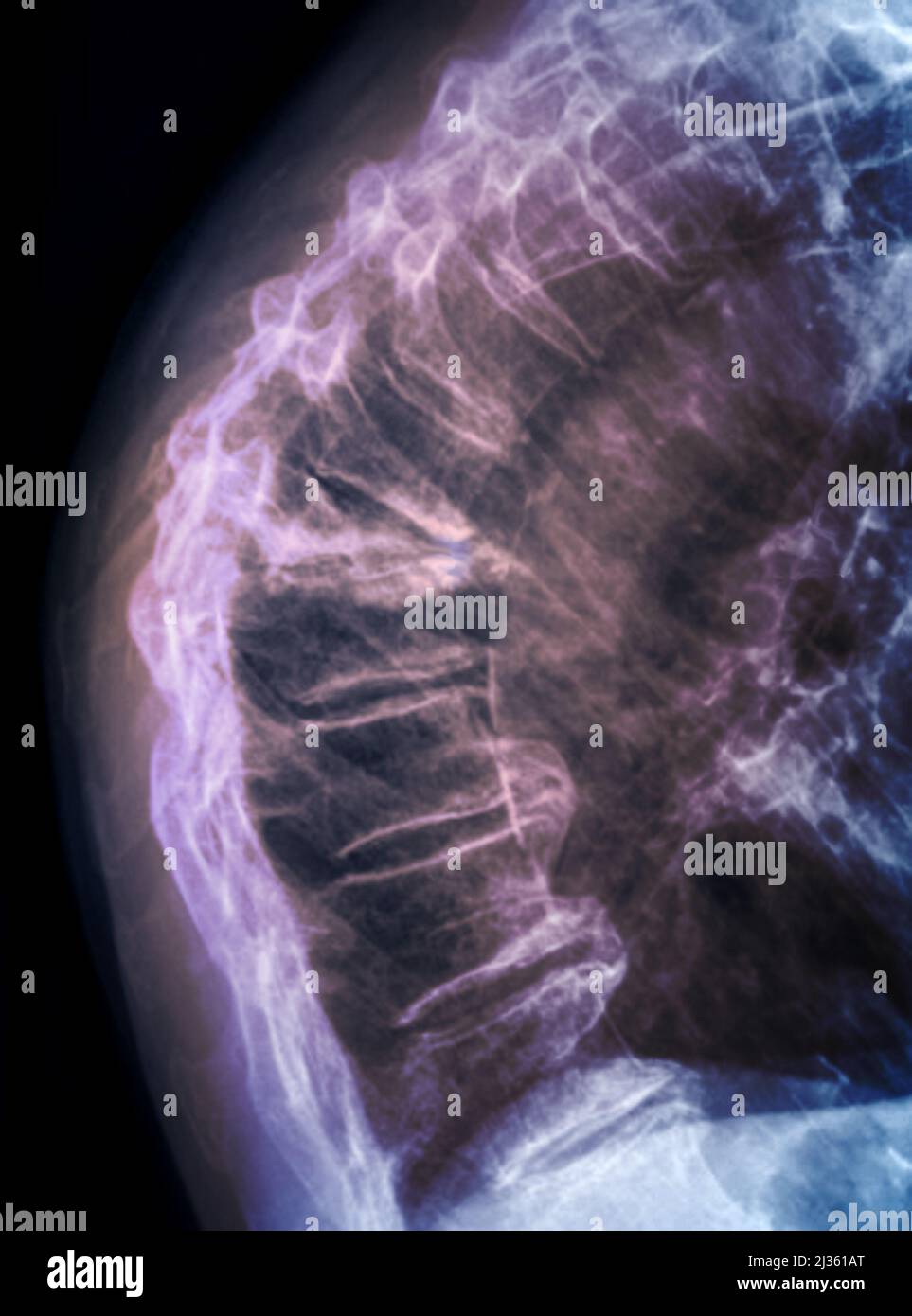 Osteoporotic spinal compression, X-ray Stock Photo - Alamy