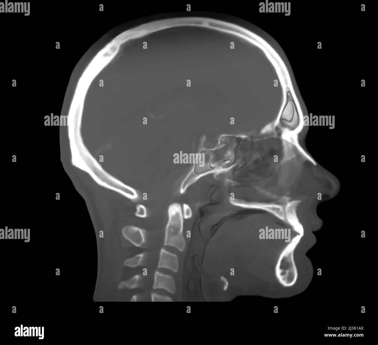 Normal nasopharynx, CT scan Stock Photo - Alamy