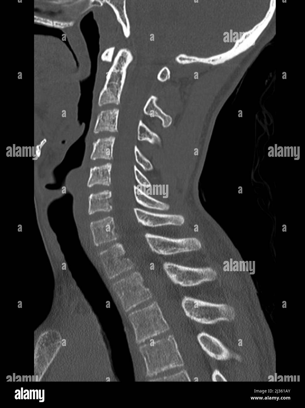 Healthy cervical spine, CT scan Stock Photo - Alamy