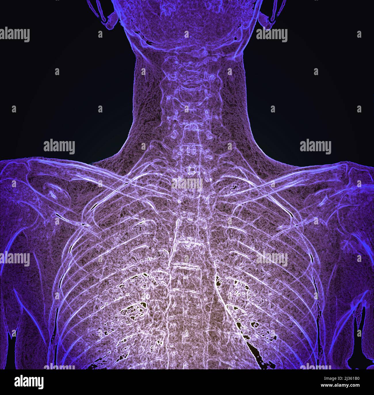 Healthy rib cage, X-ray Stock Photo - Alamy