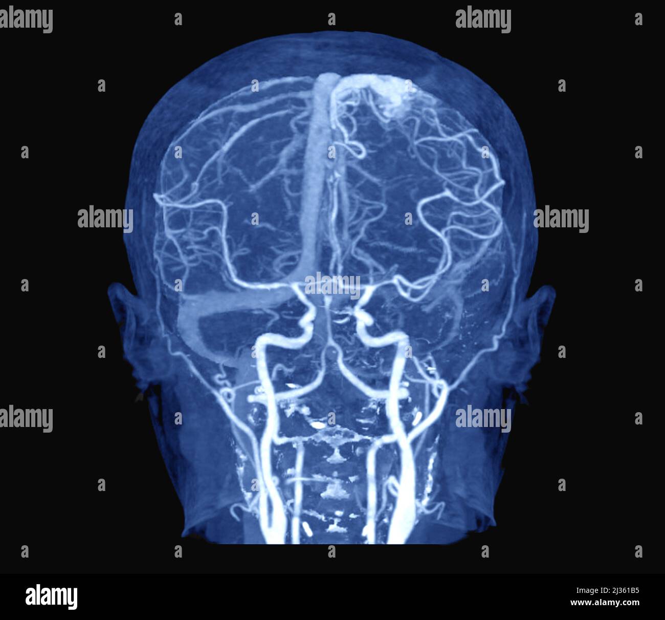 Arteriovenous malformation, CT angiogram Stock Photo - Alamy