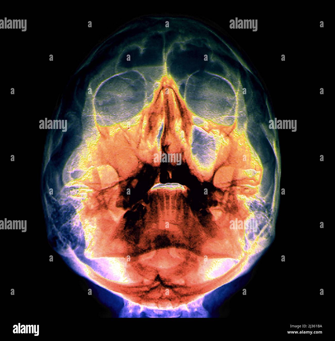 Infected paranasal sinuses, X-ray Stock Photo - Alamy