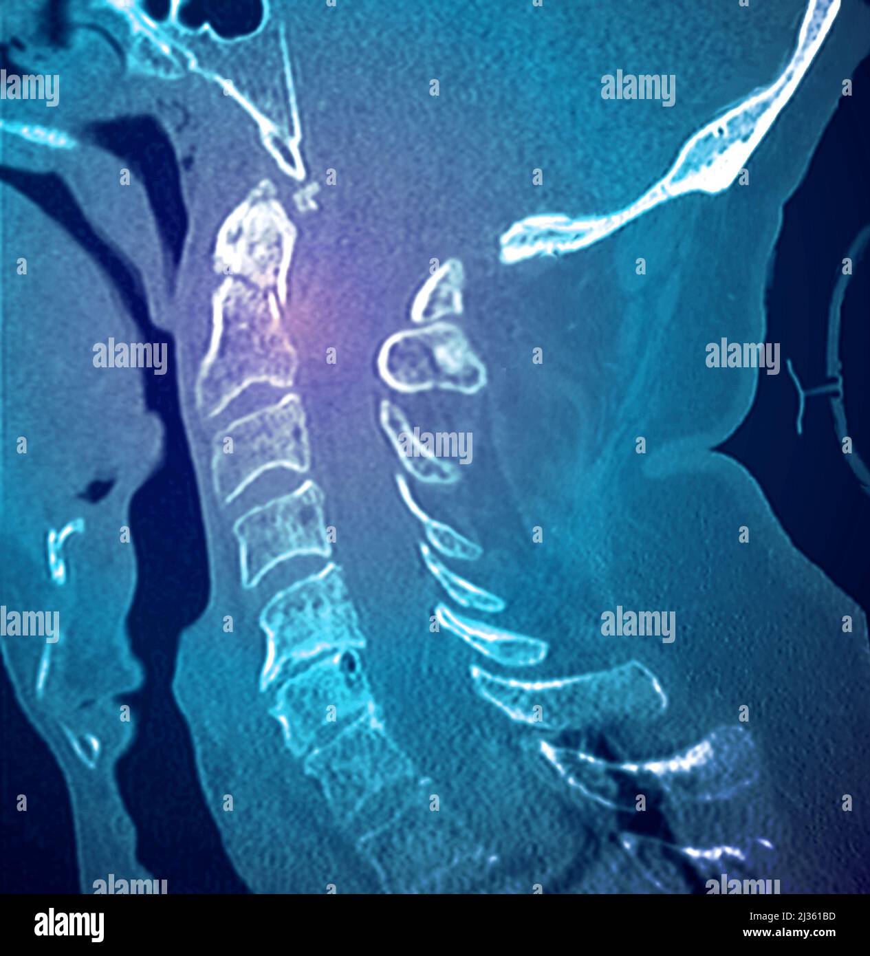 Injured cervical spine, CT scan Stock Photo - Alamy