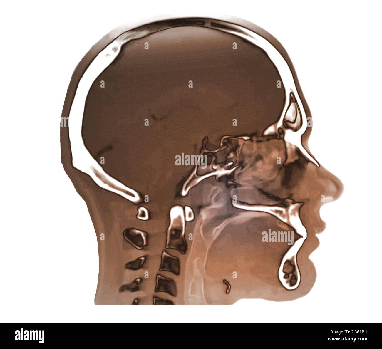Normal nasopharynx, CT scan Stock Photo - Alamy