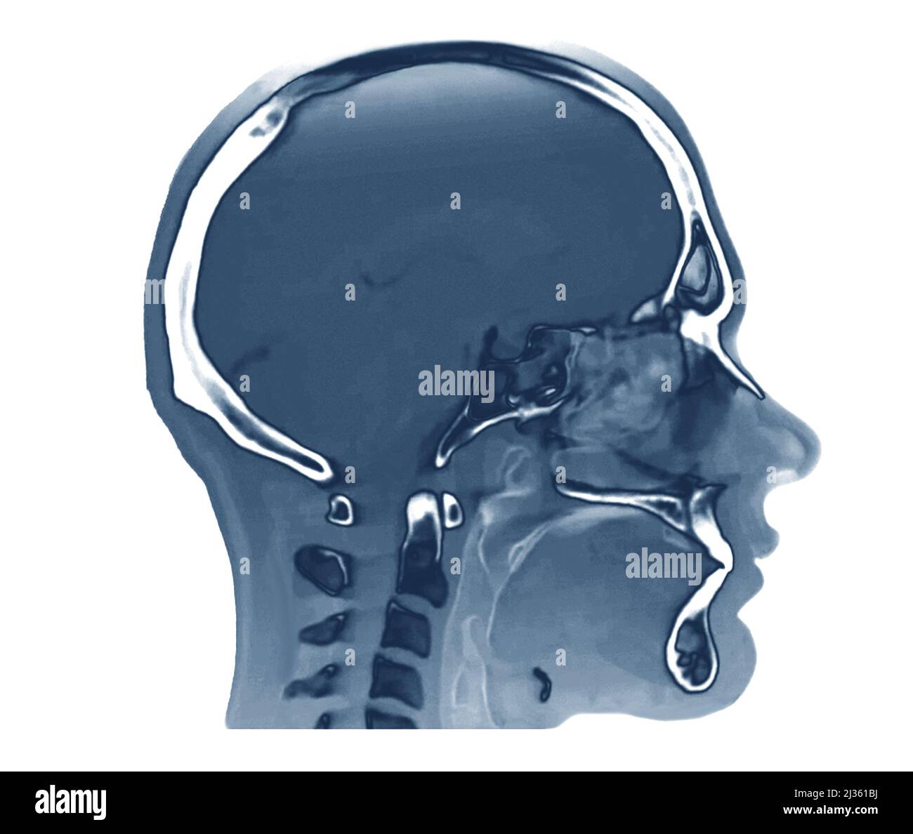 Normal nasopharynx, CT scan Stock Photo - Alamy