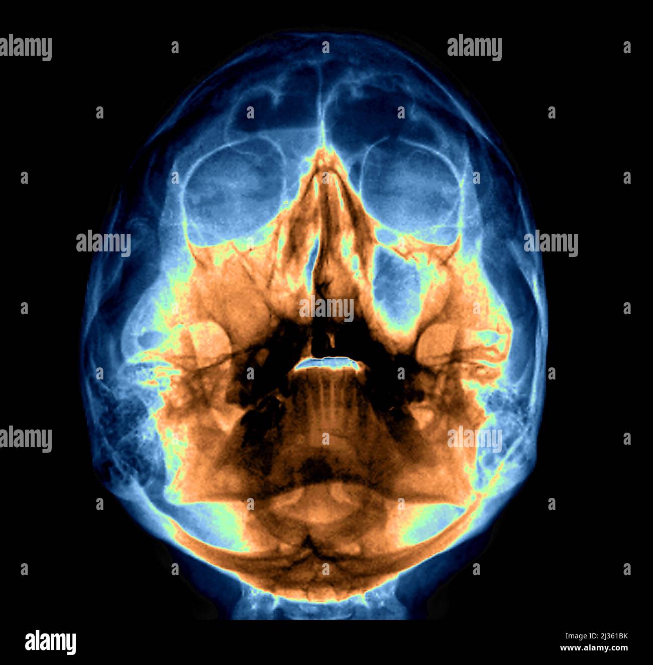 Infected paranasal sinuses, X-ray Stock Photo - Alamy