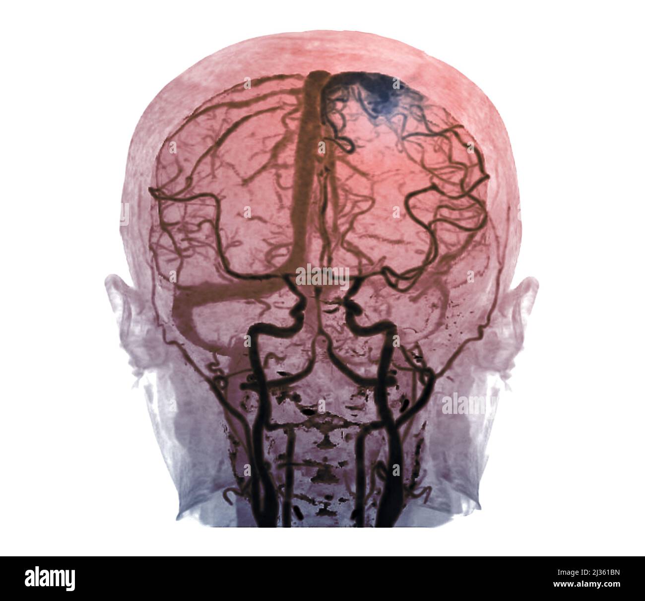 Arteriovenous malformation, CT angiogram Stock Photo - Alamy