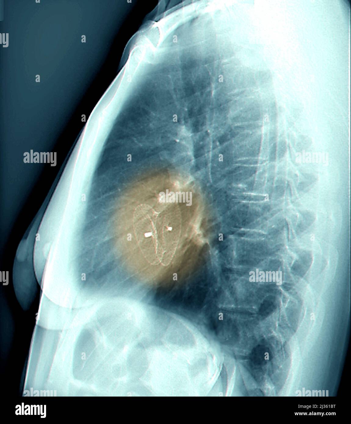 Occluder device used to treat atrial septum defect, X-ray Stock Photo ...