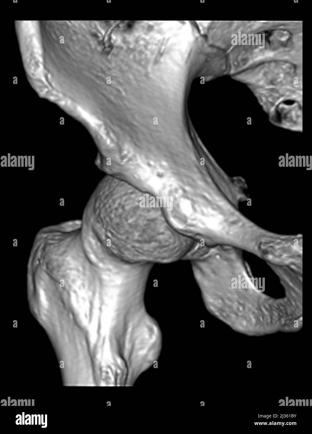 Healthy hip joint, CT scan Stock Photo - Alamy
