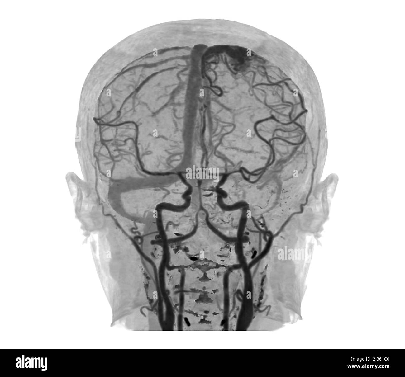 Arteriovenous malformation, CT angiogram Stock Photo - Alamy