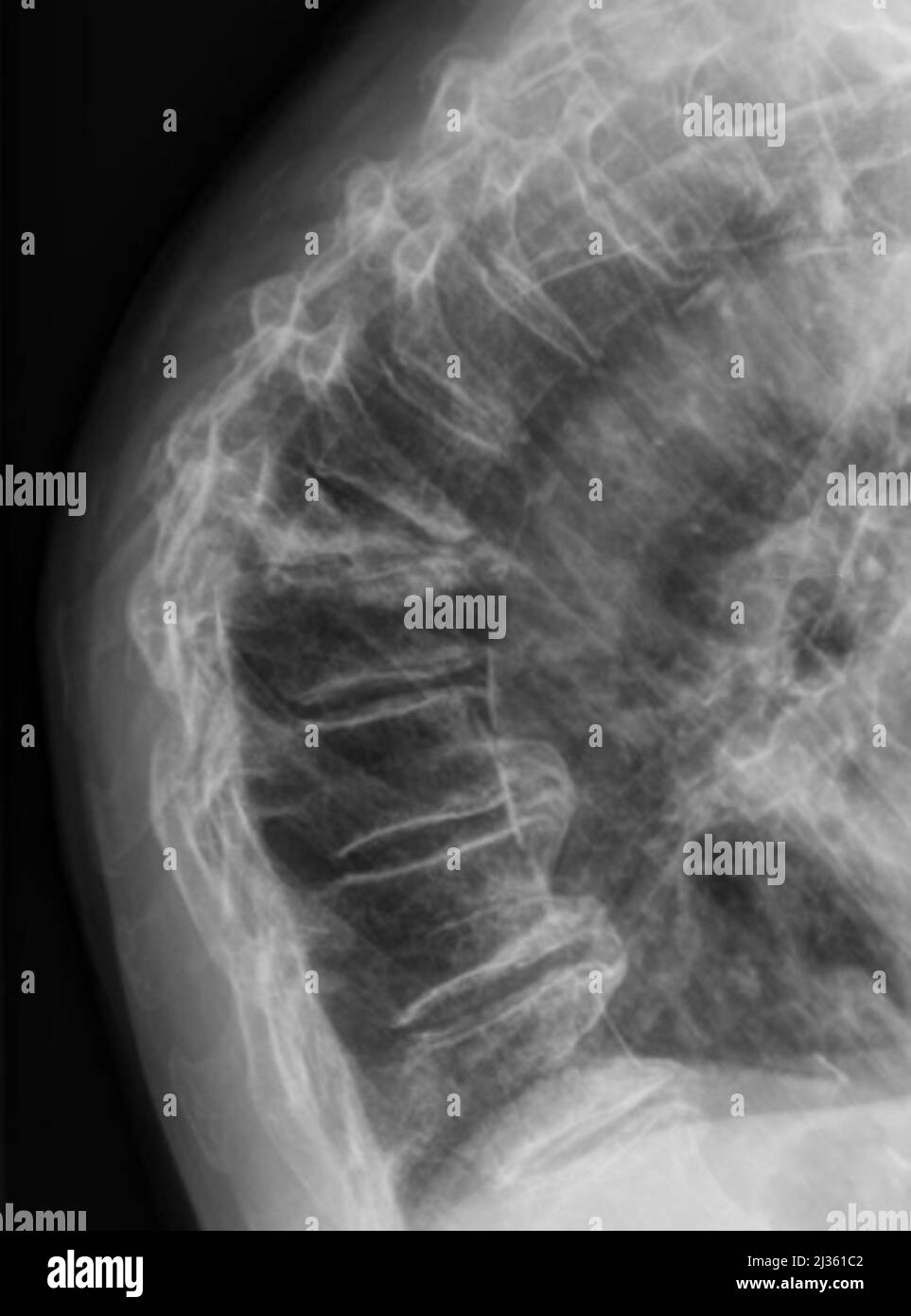 Osteoporotic spinal compression, X-ray Stock Photo - Alamy
