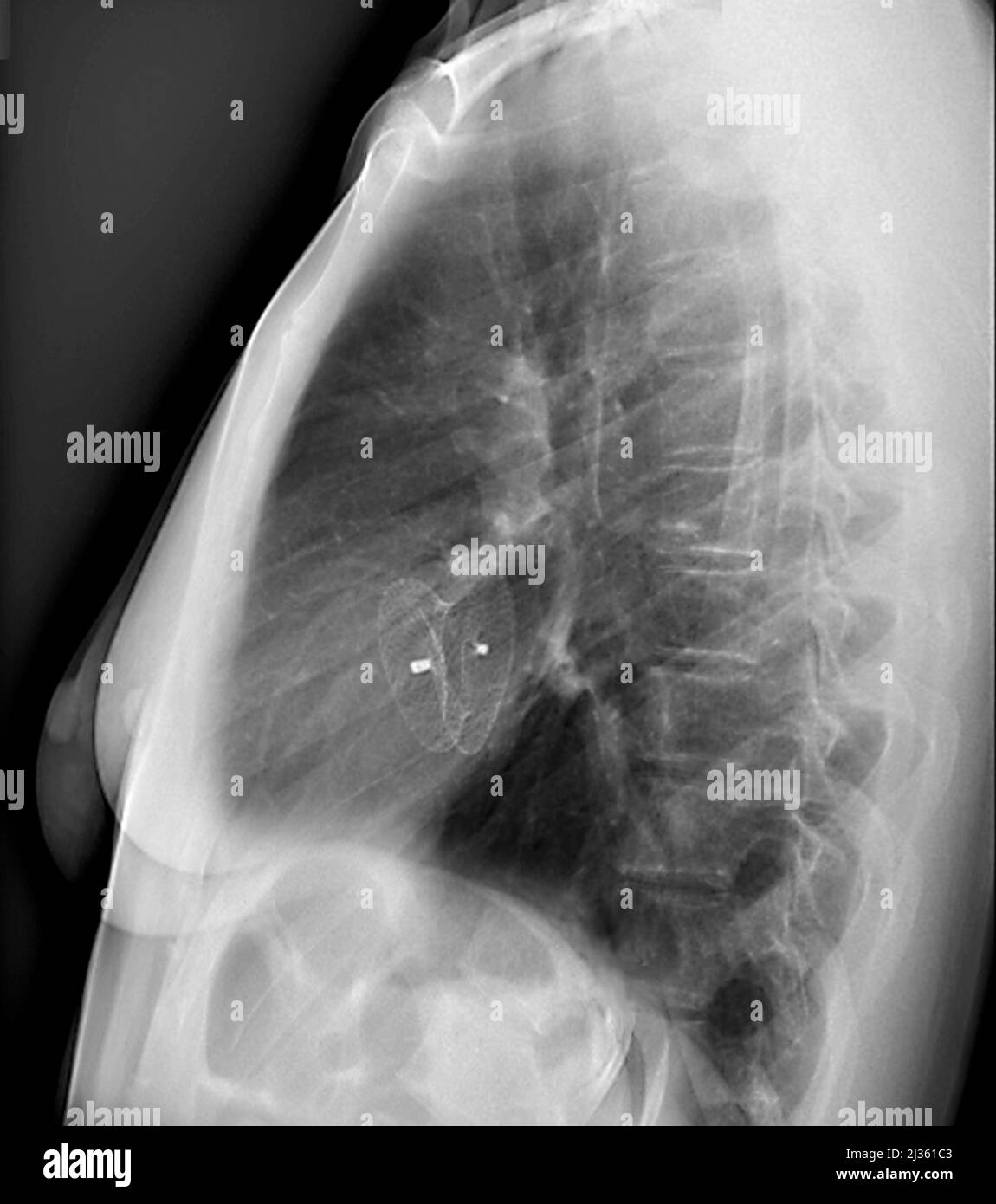 Occluder device used to treat atrial septum defect, X-ray Stock Photo ...