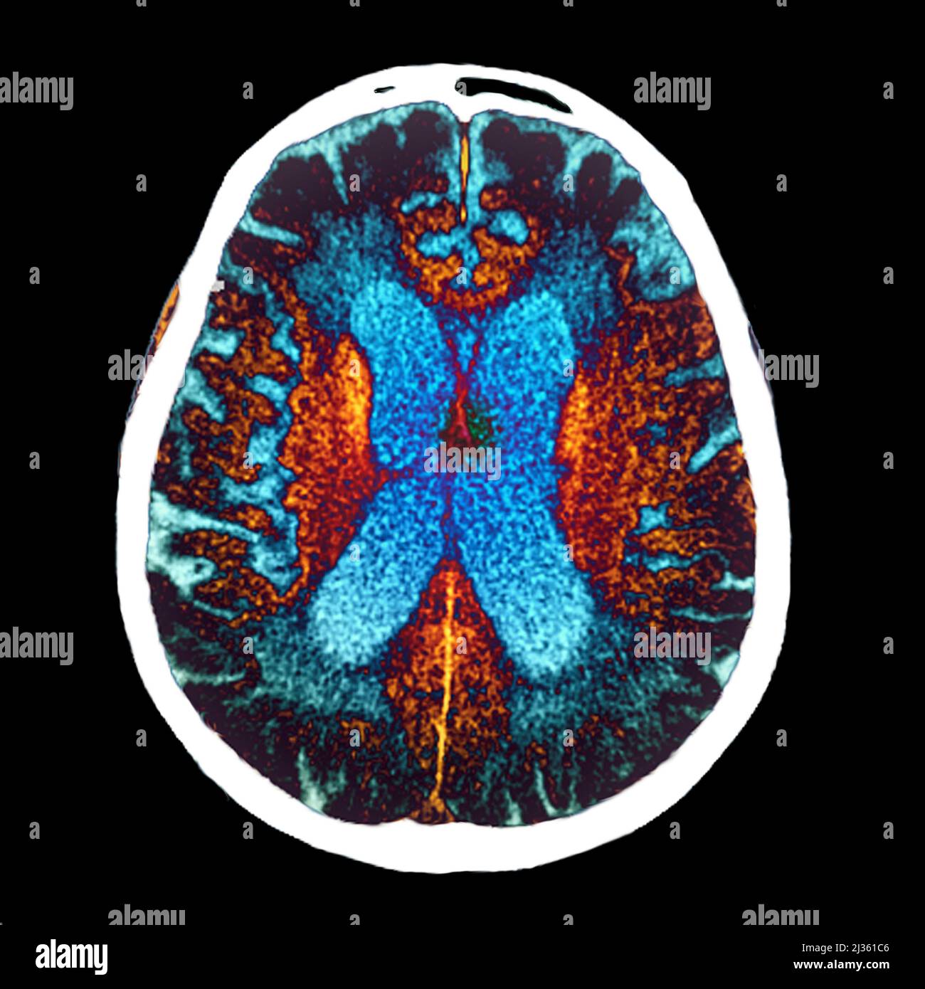 Alzheimer's disease, CT scan Stock Photo - Alamy