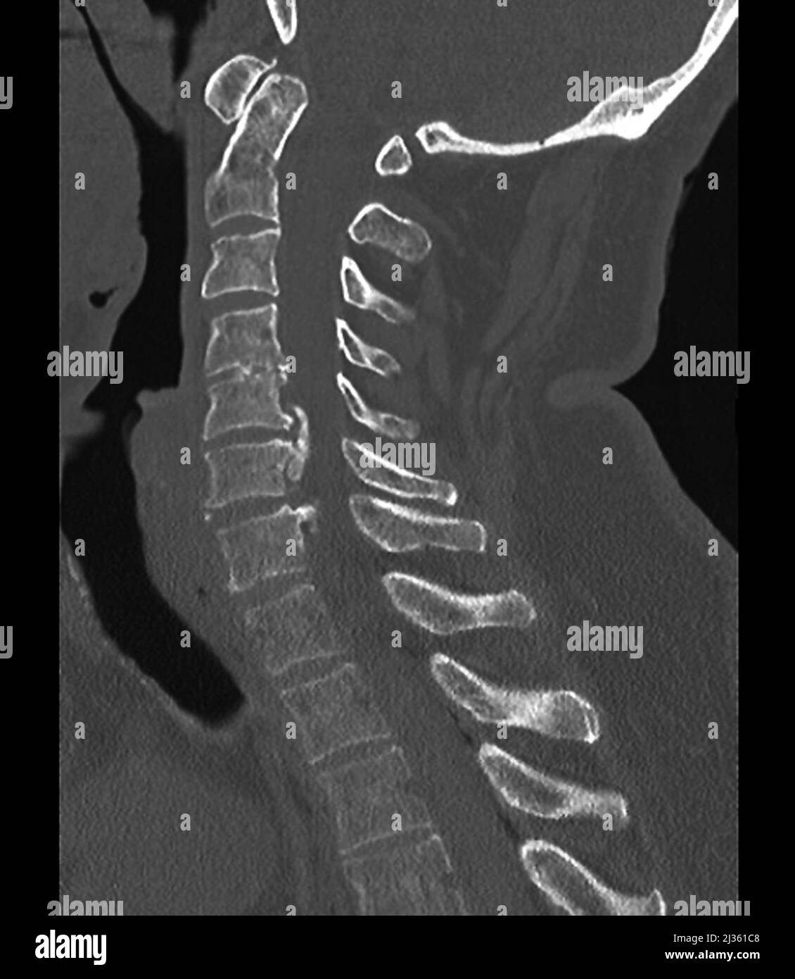Osteoarthritis of the cervical spine, CT scan Stock Photo - Alamy