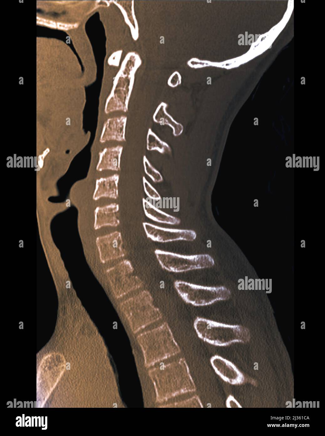 Healthy cervical spine, CT scan Stock Photo - Alamy Healthy cervical spine, CT scan Stock Photo - Alamy