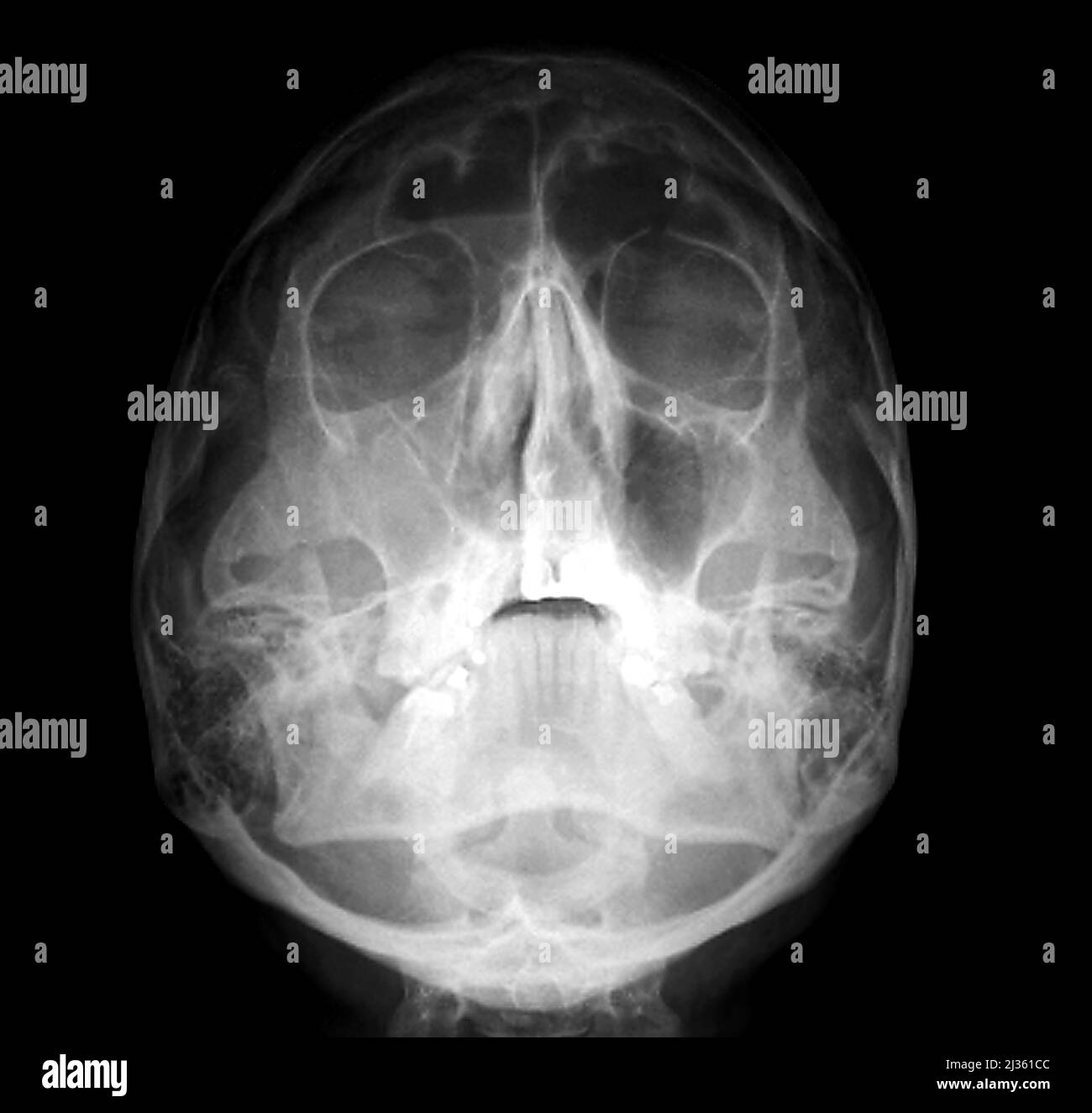 Infected paranasal sinuses, X-ray Stock Photo - Alamy