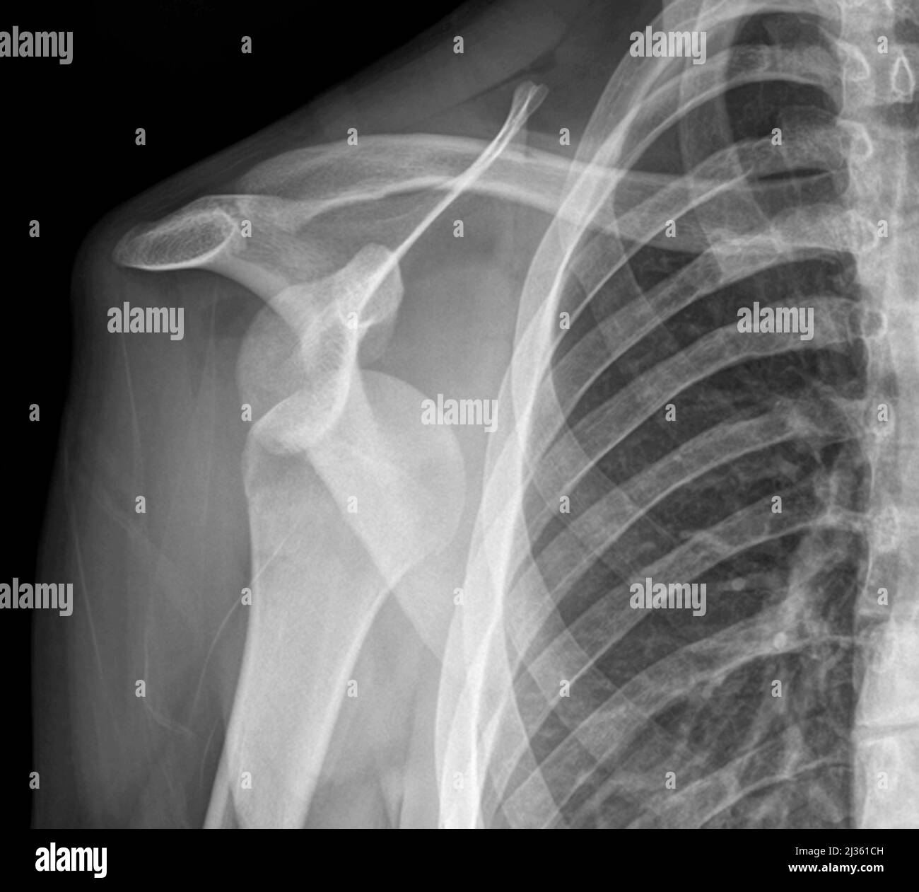 Dislocated right shoulder, X-ray Stock Photo - Alamy