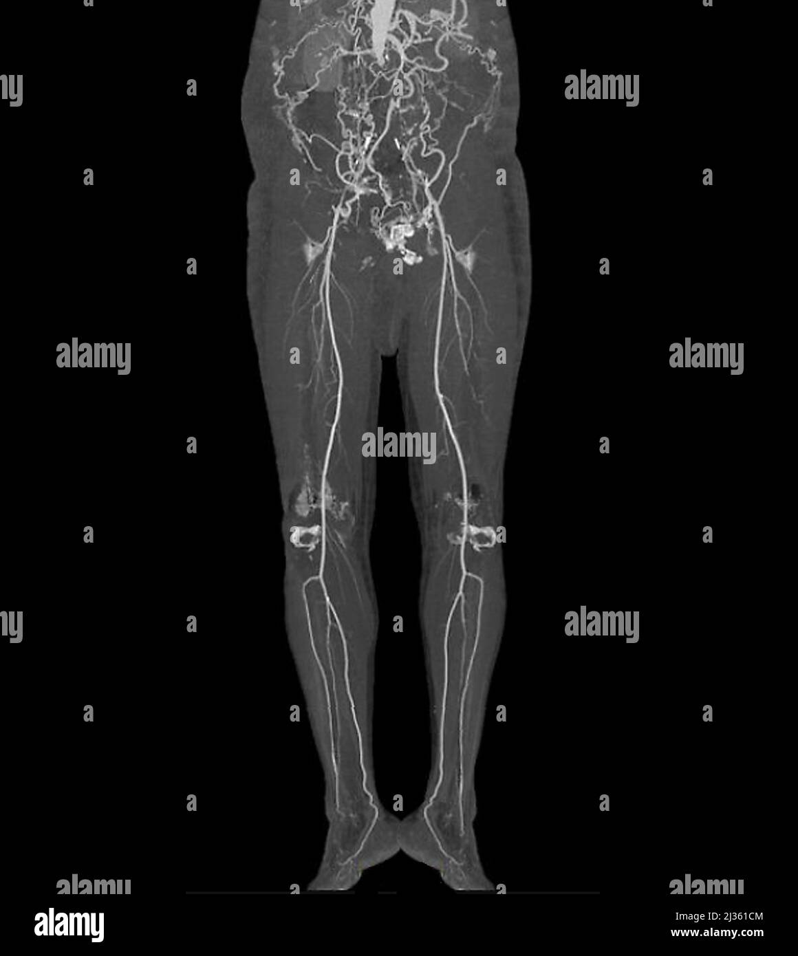 Aortoiliac occlusive disease, CT angiogram Stock Photo - Alamy