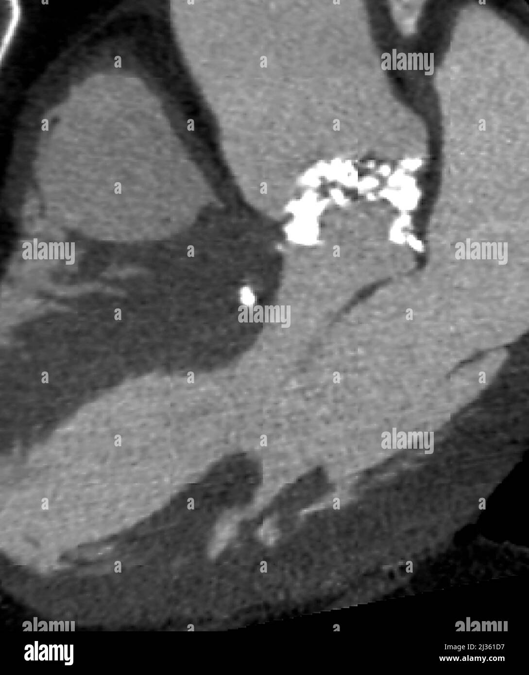 Heart valve disease, CT angiogram Stock Photo - Alamy