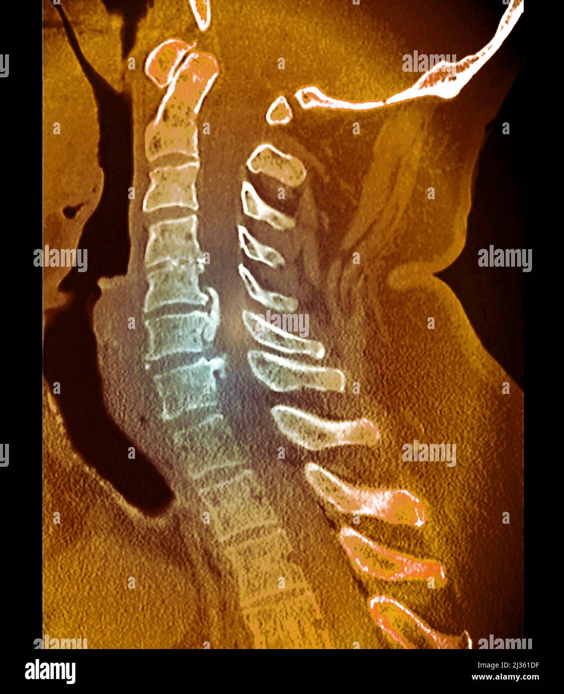 Osteoarthritis of the cervical spine, CT scan Stock Photo - Alamy