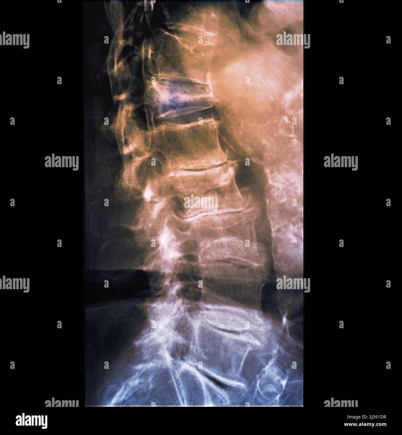 Osteoarthritis of the lumbar spine, X-ray Stock Photo - Alamy