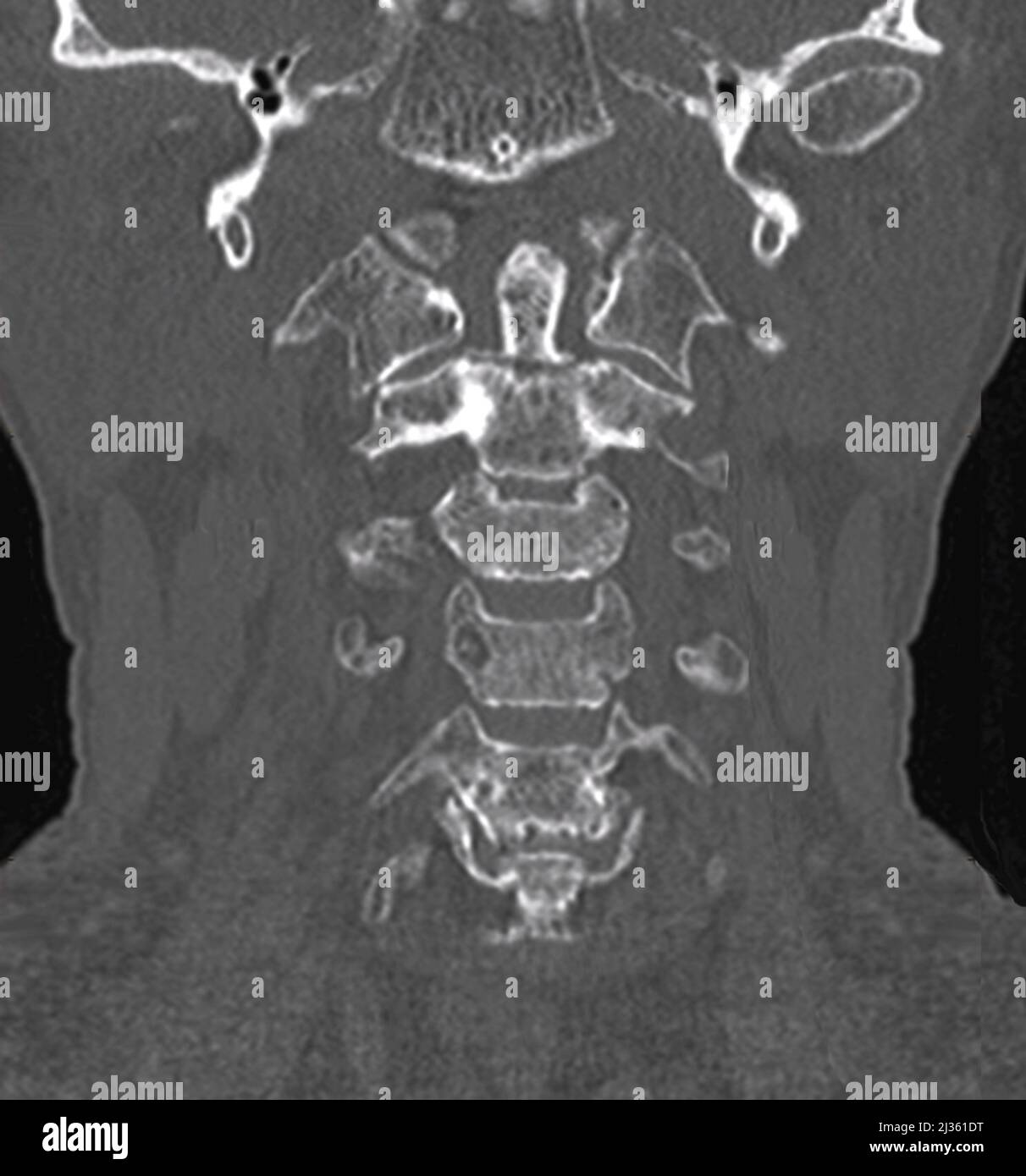 Fractured cervical vertebra, CT scan Stock Photo - Alamy