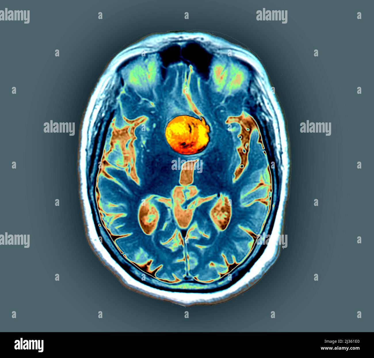 Aneurysm of the internal carotid artery, MRI scan Stock Photo - Alamy