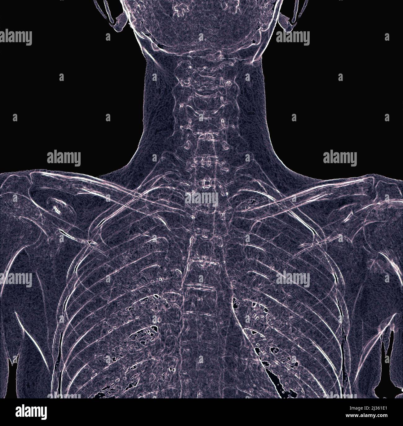 Healthy rib cage, X-ray Stock Photo - Alamy
