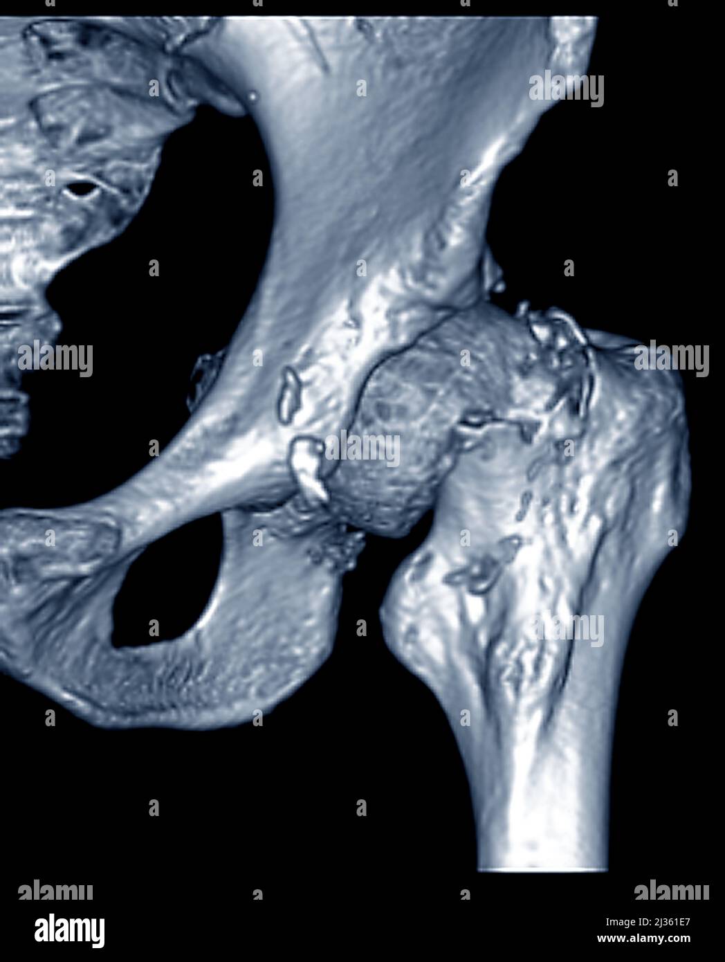 Hip fracture, CT scan Stock Photo - Alamy
