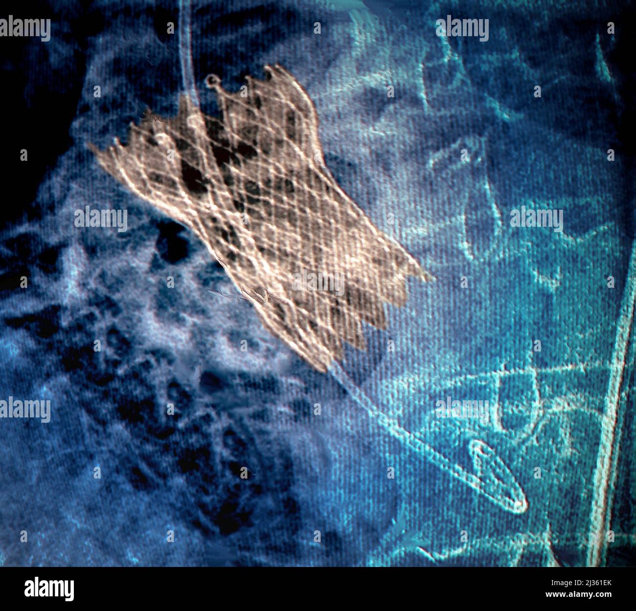 Prosthetic aortic valve, X-ray Stock Photo - Alamy