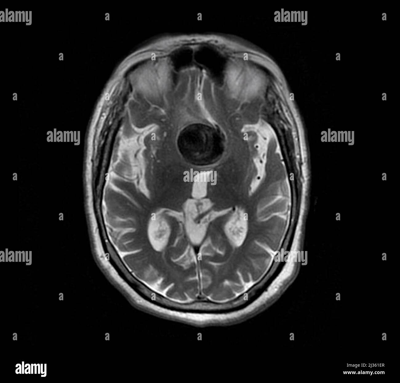Aneurysm of the internal carotid artery, MRI scan Stock Photo - Alamy