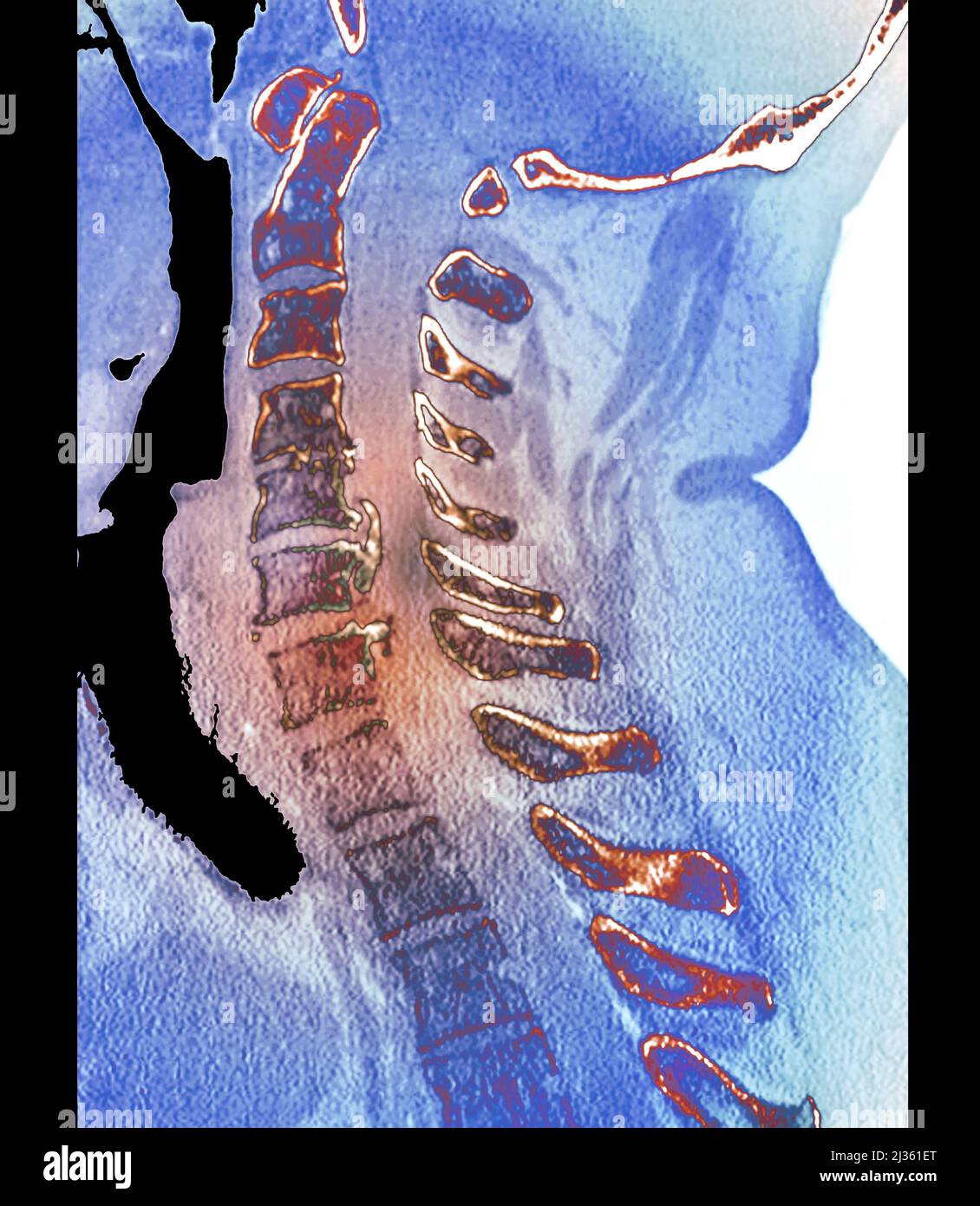 Osteoarthritis of the cervical spine, CT scan Stock Photo - Alamy
