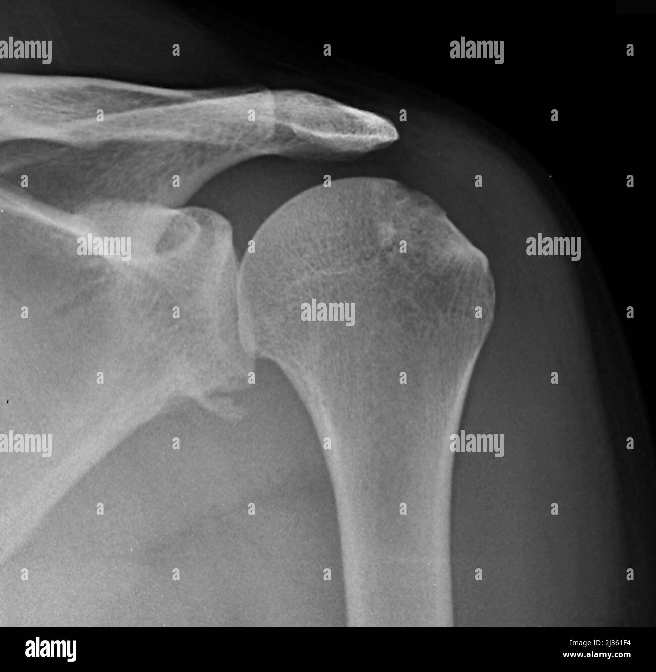 Bone fragment of the left shoulder, X-ray Stock Photo - Alamy
